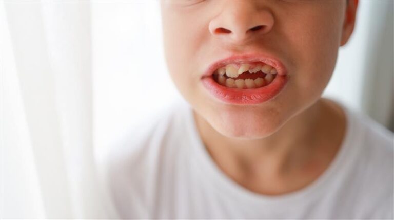 What Are “Thumb Sucking Teeth?” | Timberlane Pediatric Dentistry ...